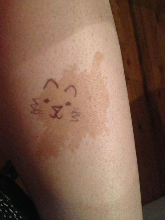 แผลเป็น ซ่อนเร้นได้ ด้วยศิลปะการสัก หรือที่เรียกว่า tattoos ...